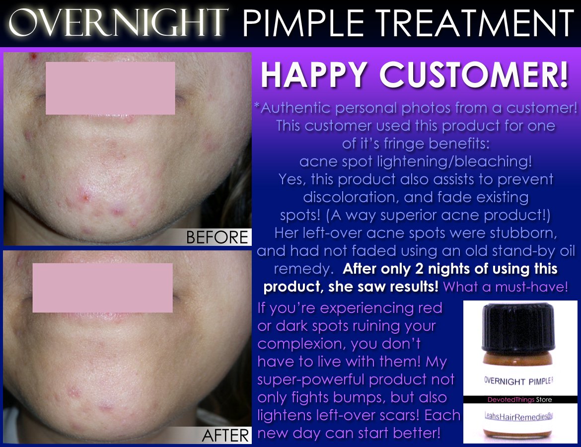 Fast Overnight Pimple Treatment for Zits, Boils, and Cysts All in 1 Remedy