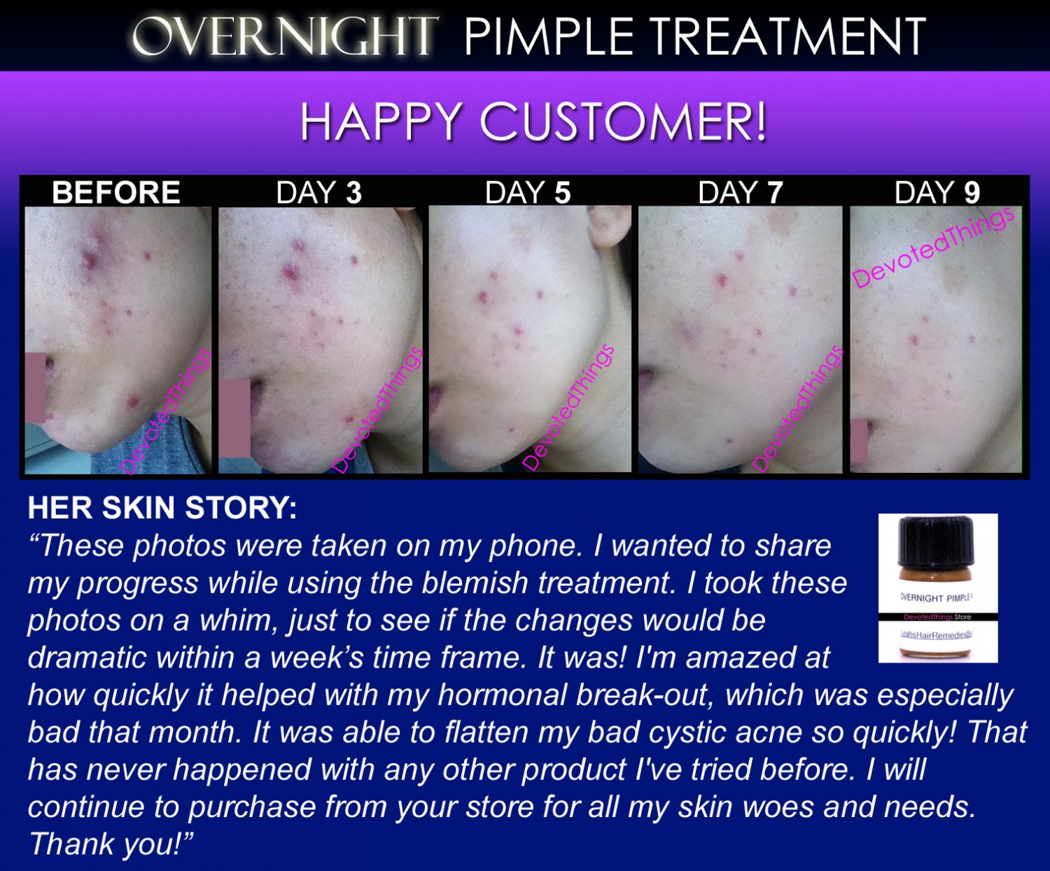 Fast Overnight Pimple Treatment for Zits, Boils, and Cysts All in 1 Remedy