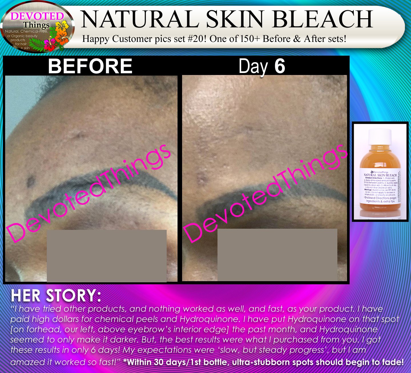 15+ Before and After pics Natural Skin Bleaching Product Acne Scar ...