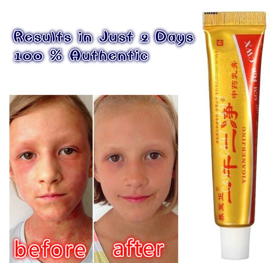 Most effective cream for Eczema,Skin rash,Psoriasis, Dermatitis