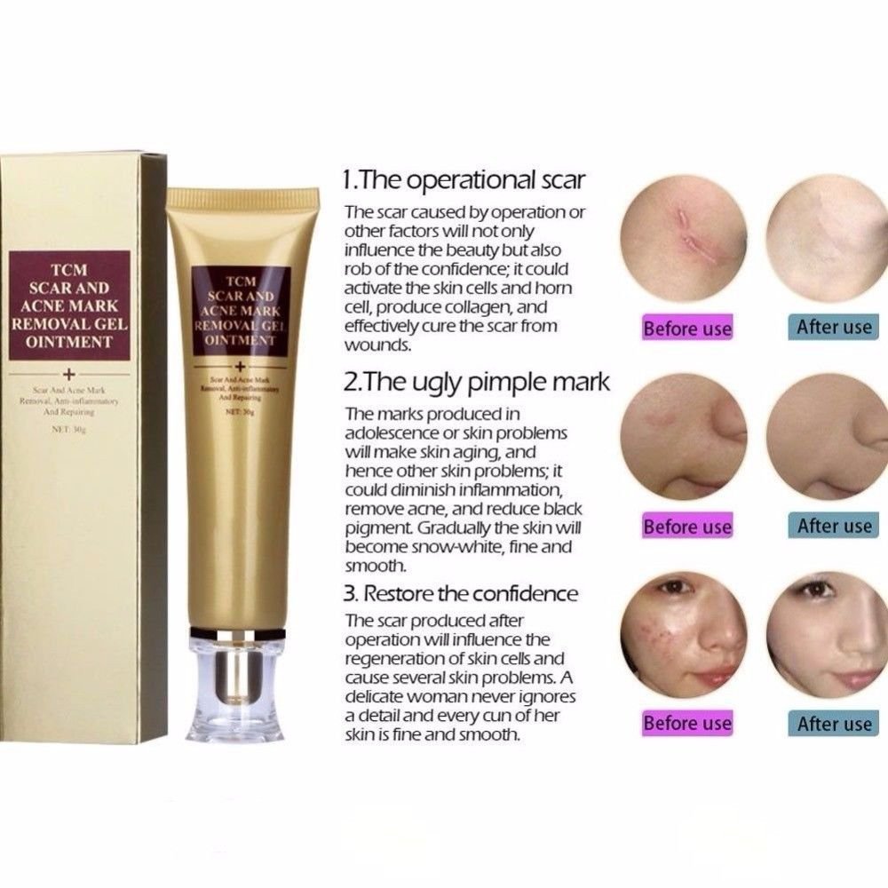 TCM SCAR AND ACNE MARK REMOVAL GEL OINTMENT (30g) Acne Scar Cream