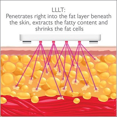 Silk’n Lipo - Targeted Fat Reduction Device