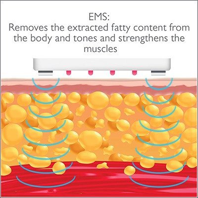 Silk’n Lipo - Targeted Fat Reduction Device