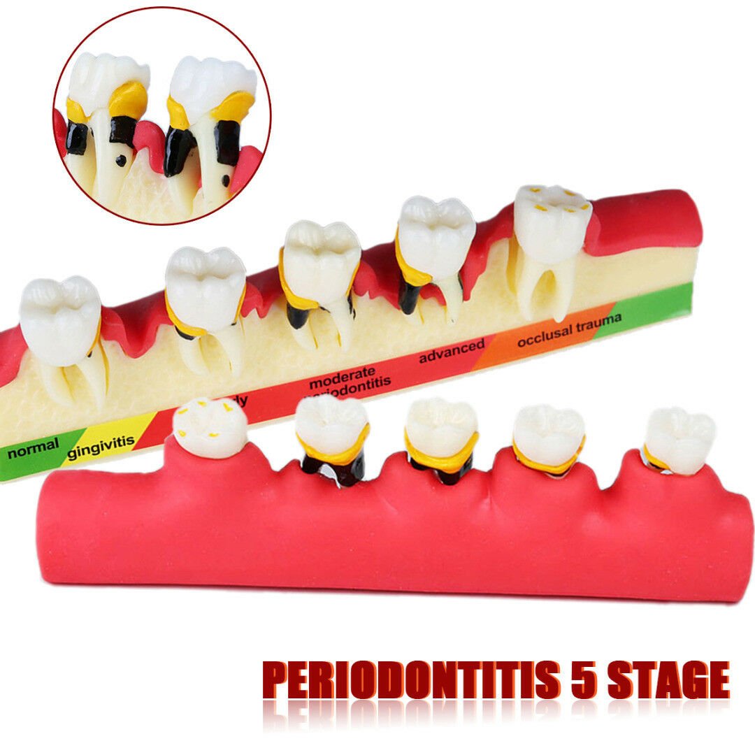 Dental Periodontitis 5 Stage Model Dental Teeth Teaching Study Model ...