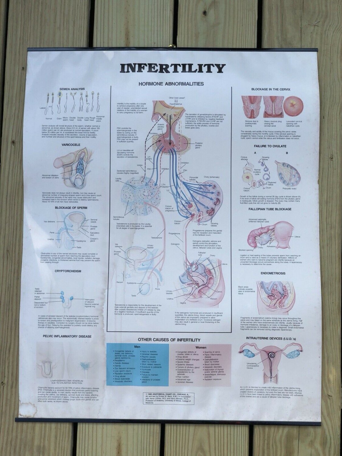 1985 Infertility Medical Explanation Poster 25” x 20”