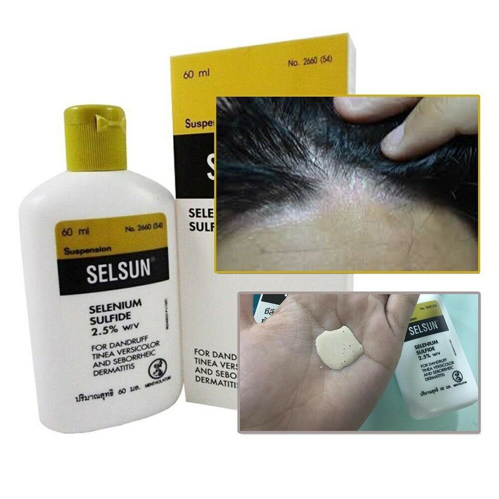 FAST SHIP SELSUN Anti-Dandruff Itching Selenium Sulfide 2.5% Shampoo ...