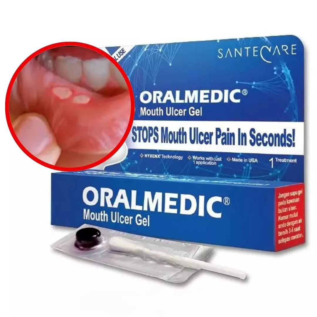 3 X Oralmedic Mouth Ulcer Gel 1 Treatment Fast Pain Relief Made in USA