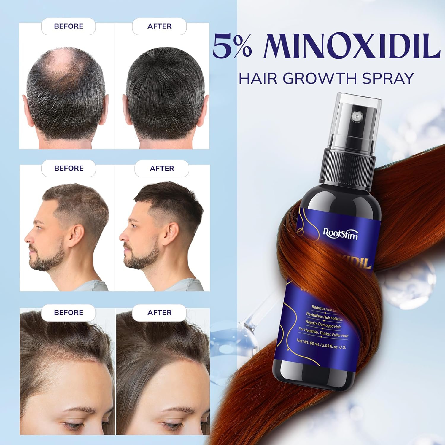 Minoxidil 5% Extra Strength – Hair Serum for Men & Women